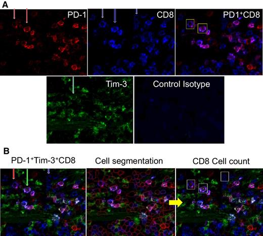 Tim-3 Expression on Tumor-Infiltrating PD-1+CD8+ T Cells Correlates ...