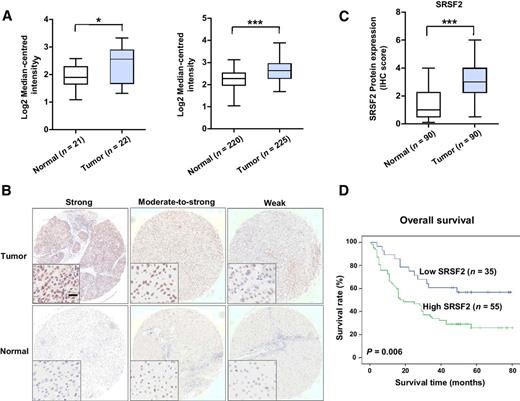 SRSF2 Regulates Alternative Splicing to Drive Hepatocellular Carcinoma ...