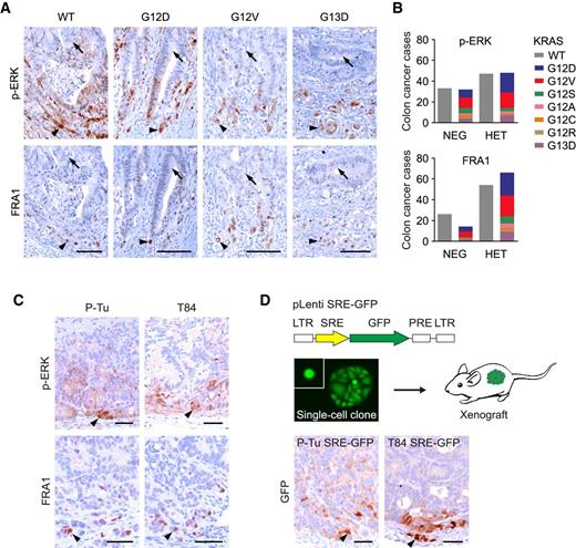 Oncogenic Effects of High MAPK Activity in Colorectal Cancer Mark ...