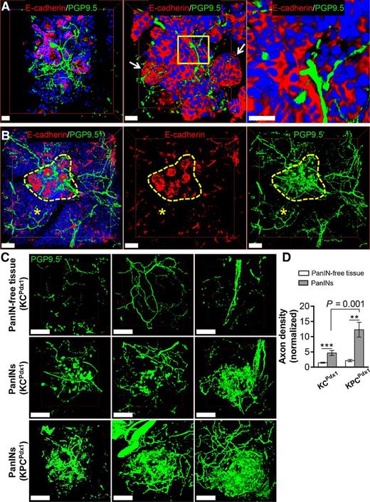 PanIN Neuroendocrine Cells Promote Tumorigenesis via Neuronal Cross ...