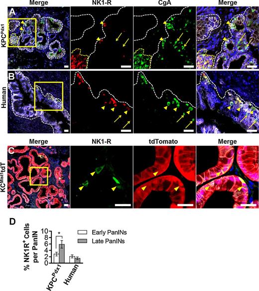 PanIN Neuroendocrine Cells Promote Tumorigenesis via Neuronal Cross ...