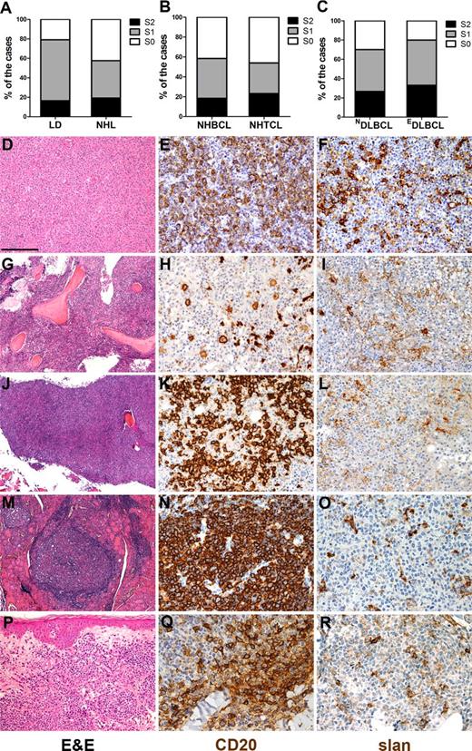 slan+ Monocytes and Macrophages Mediate CD20-Dependent B-cell Lymphoma ...