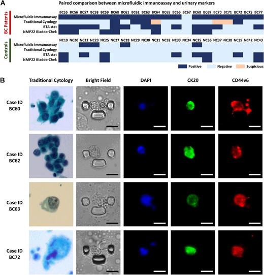 Detection of Urothelial Bladder Carcinoma via Microfluidic Immunoassay ...