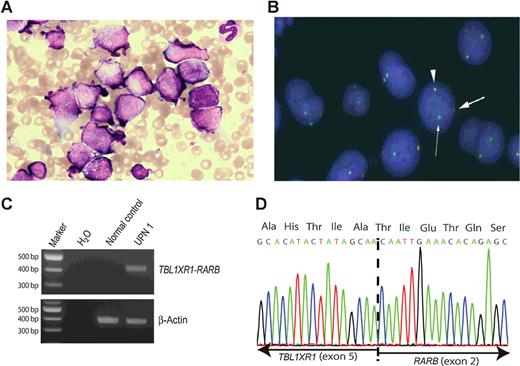 Recurrent RARB Translocations in Acute Promyelocytic Leukemia Lacking ...
