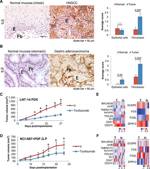 IL-6 Mediates Cross-Talk between Tumor Cells and Activated Fibroblasts ...