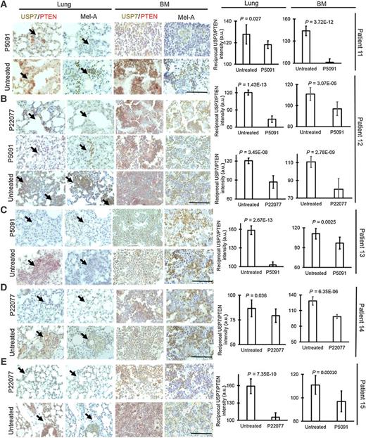 Targeting USP7 Identifies a Metastasis-Competent State within Bone ...