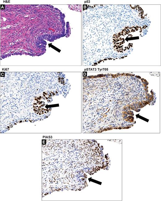 STAT3/PIAS3 Levels Serve as “Early Signature” Genes in the Development ...