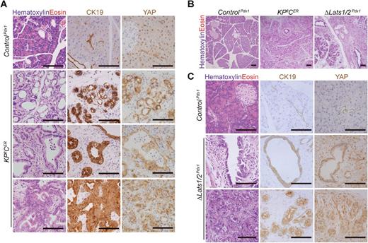 YAP and AP-1 Cooperate to Initiate Pancreatic Cancer Development from ...
