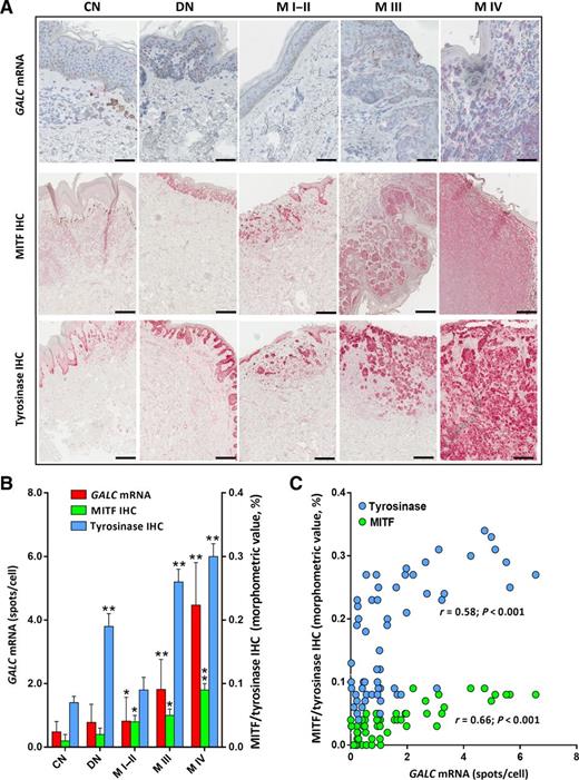 β-Galactosylceramidase Promotes Melanoma Growth via Modulation of ...