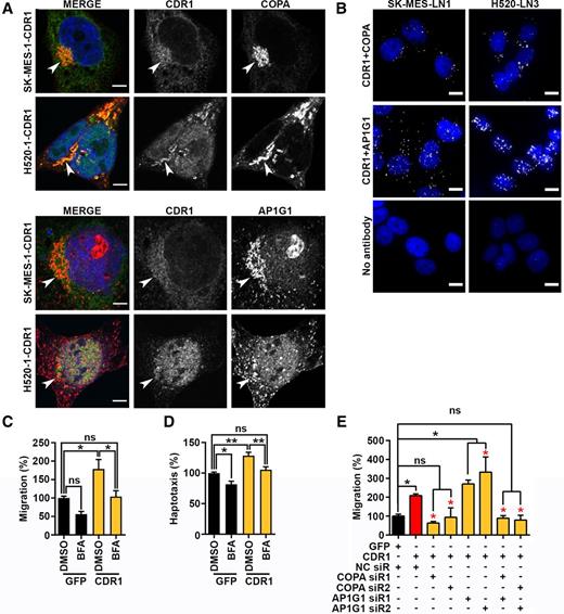 A Circle RNA Regulatory Axis Promotes Lung Squamous Metastasis via CDR1 ...