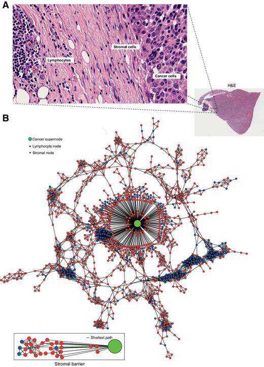 Topological Tumor Graphs: A Graph-Based Spatial Model to Infer Stromal ...