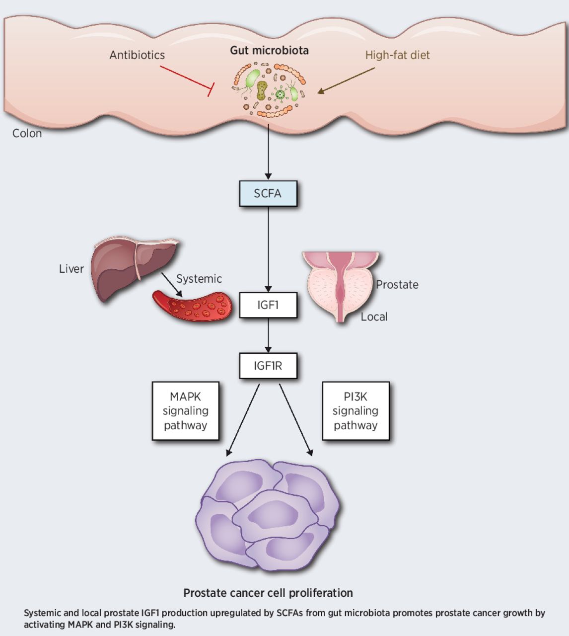 Gut Microbiota–Derived Short-Chain Fatty Acids Promote Prostate Cancer Growth via IGF1 Signaling ...