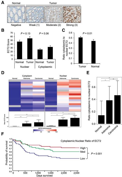 Aberrant Expression and Subcellular Localization of ECT2 Drives ...