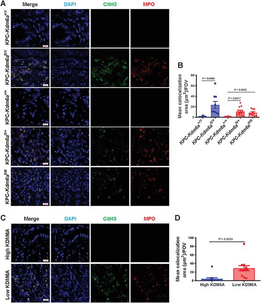 KDM6A Loss Recruits Tumor-Associated Neutrophils and Promotes ...