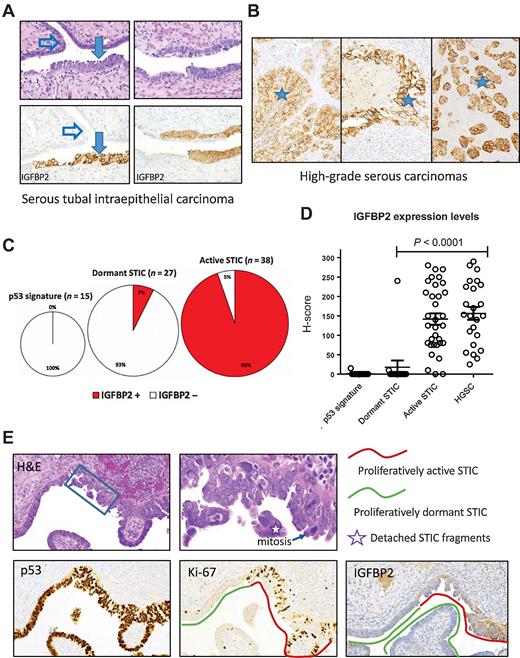 Spatial Transcriptomic Analysis of Ovarian Cancer Precursors Reveals ...