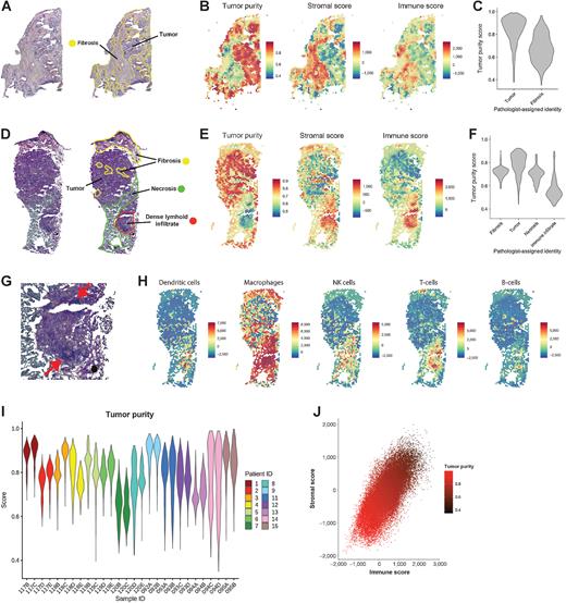 Spatial Transcriptomic Analysis of a Diverse Patient Cohort Reveals a ...
