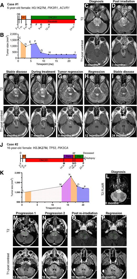 ONC201 in Combination with Paxalisib for the Treatment of H3K27-Altered ...