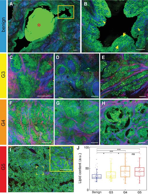 Stimulated Raman Scattering Microscopy Enables Gleason Scoring of ...