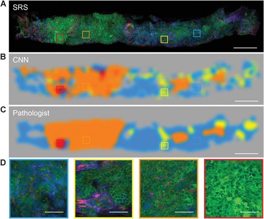 Stimulated Raman Scattering Microscopy Enables Gleason Scoring of ...