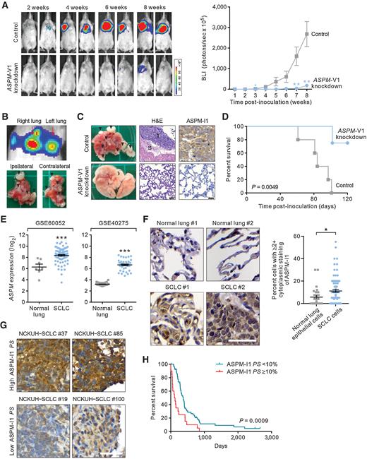 ASPM Activates Hedgehog and Wnt Signaling to Promote Small Cell Lung ...