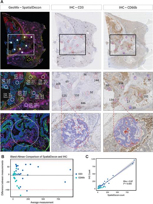 Spatially Resolved Transcriptomics Deconvolutes Prognostic Histological ...