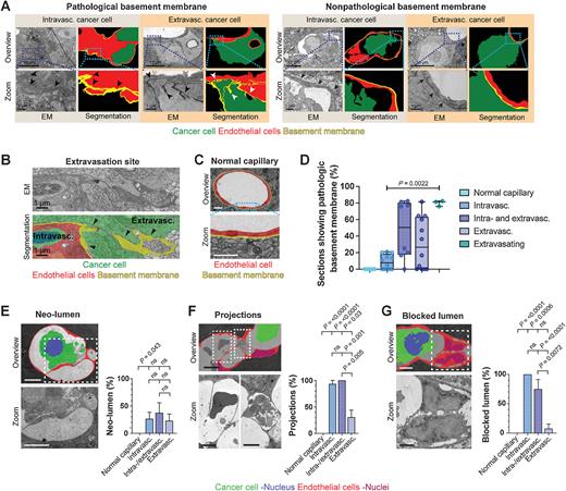 Active Remodeling of Capillary Endothelium via Cancer Cell–Derived MMP9 ...
