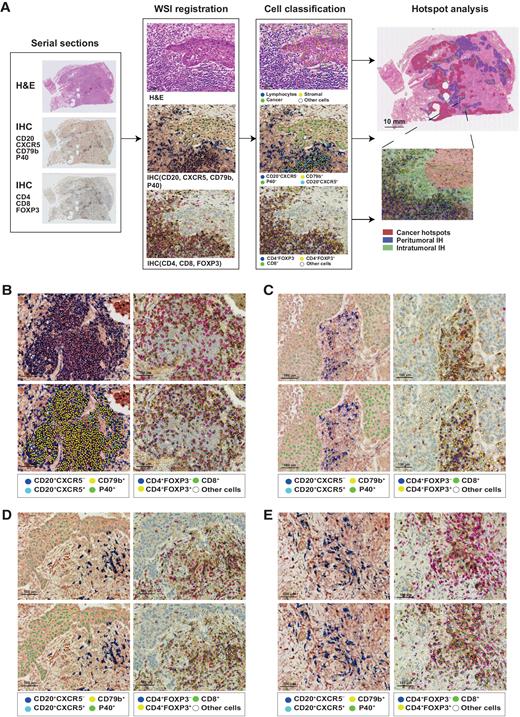 Spatial Positioning of Immune Hotspots Reflects the Interplay between B and T Cells in Lung ...