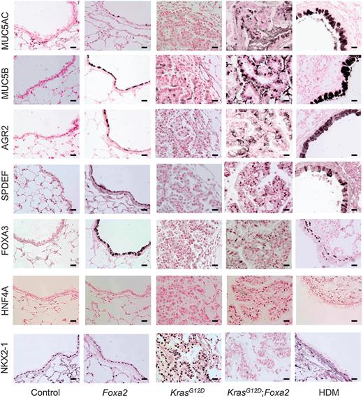 FOXA2 Cooperates with Mutant KRAS to Drive Invasive Mucinous ...