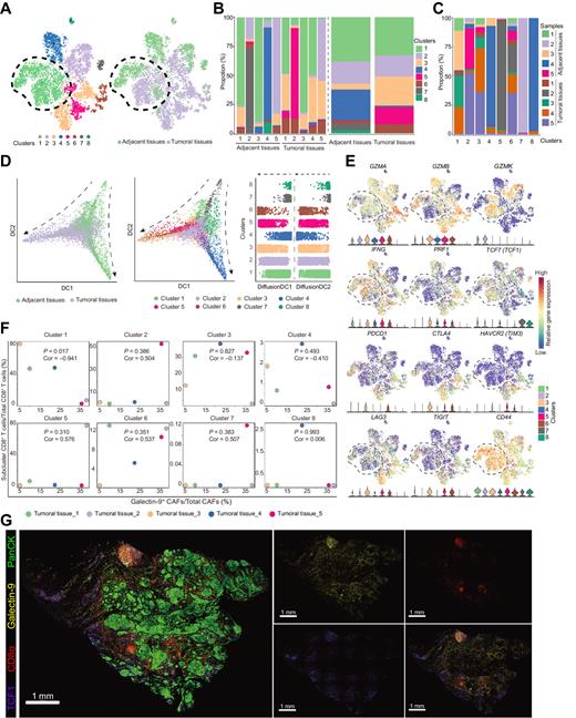 Spatial and Single-Cell Transcriptomics Reveal a Cancer-Associated ...