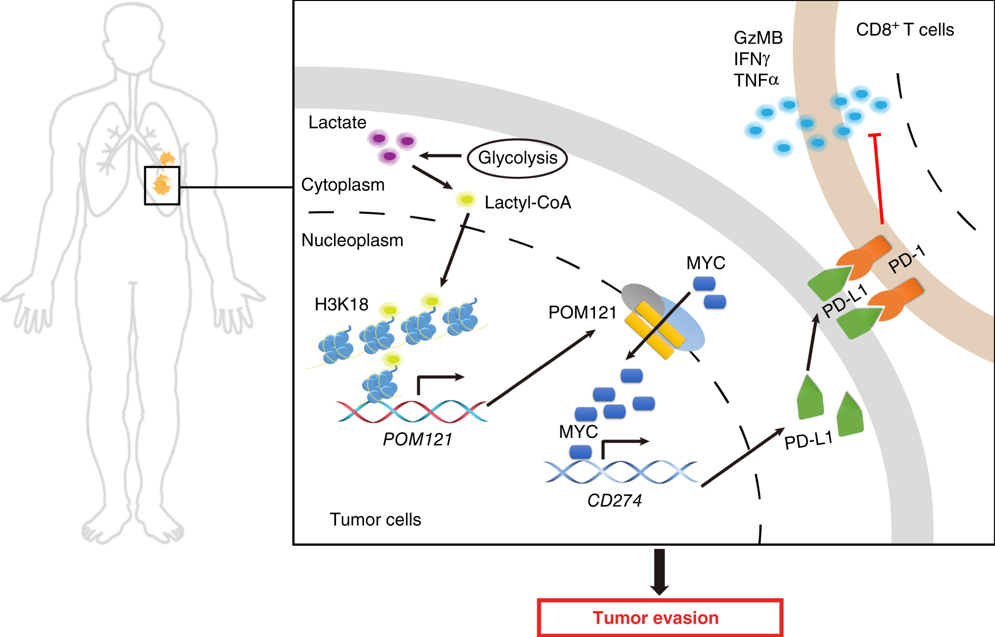 H3K18 Lactylation Potentiates Immune Escape of Non–Small Cell Lung ...