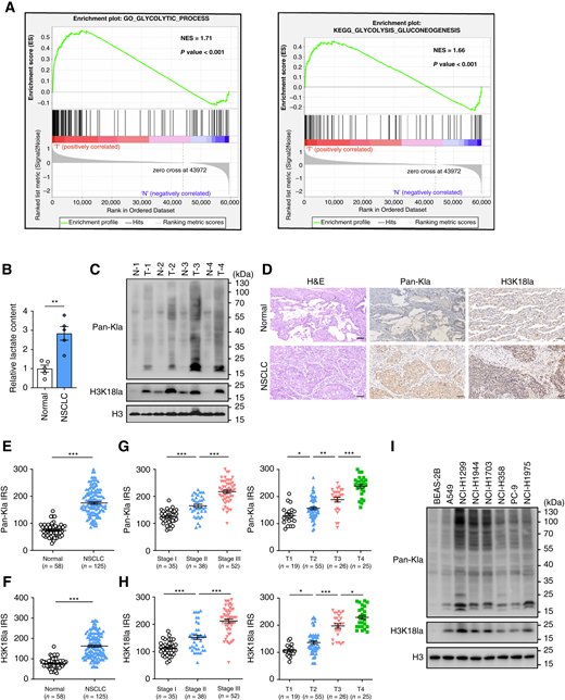 H3K18 Lactylation Potentiates Immune Escape of Non–Small Cell Lung ...