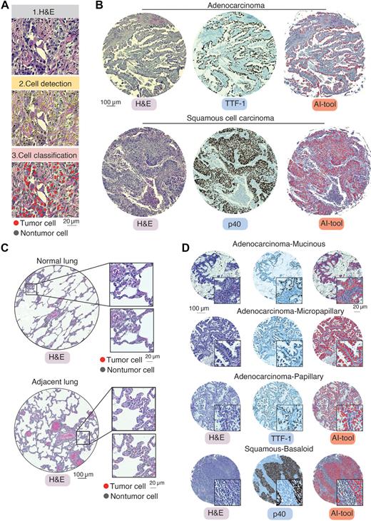 Integrating AI-Powered Digital Pathology and Imaging Mass Cytometry ...