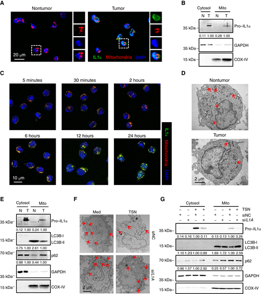 Intracellular IL1α in Peritumoral Monocytes Induces IL8 Production and ...