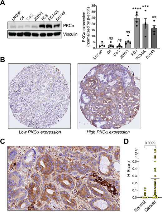 Protein Kinase C Alpha is a Central Node for Tumorigenic ...