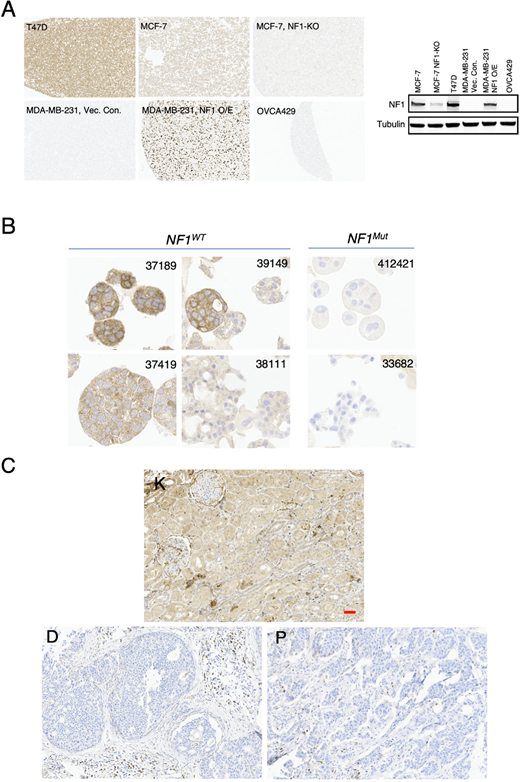 Proteogenomic Approaches for the Identification of NF1/Neurofibromin ...