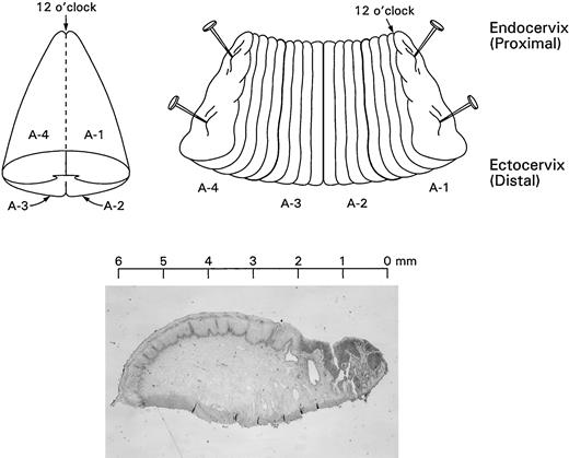 Histopathologic Extent of Cervical Intraepithelial Neoplasia 3 Lesions ...