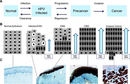 Human Papillomavirus mRNA and p16 Detection as Biomarkers for the ...