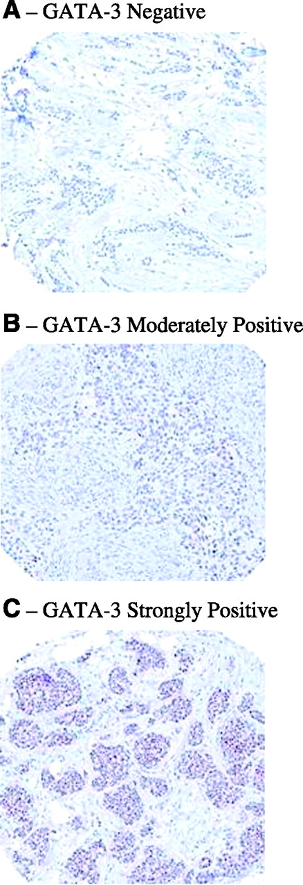 GATA-3 Expression in Breast Cancer Has a Strong Association with ...