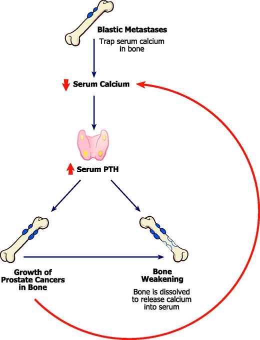 Prostate Cancer, Serum Parathyroid Hormone, and the Progression of ...