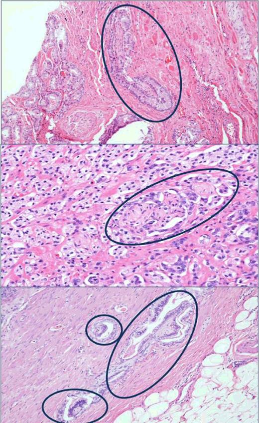 Perineural Invasion and Risk of Lethal Prostate Cancer | Cancer ...