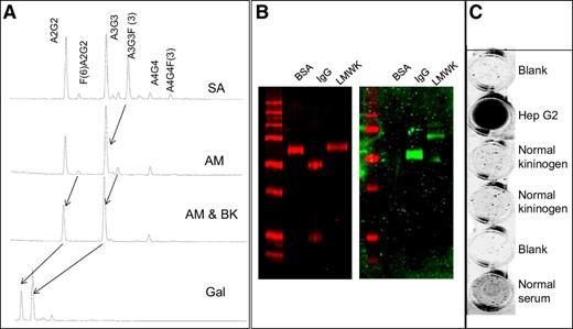 Changes in the Glycosylation of Kininogen and the Development of a ...