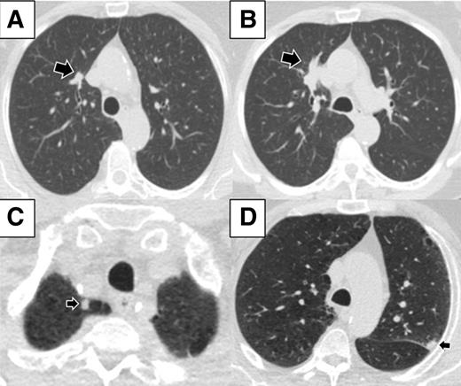 Characteristics and Outcomes of Lung Cancers Detected on Low-Dose Lung ...