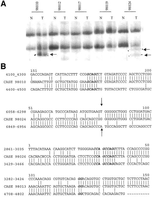 Loss of Heterozygosity and Internal Tandem Duplication Mutations of the ...