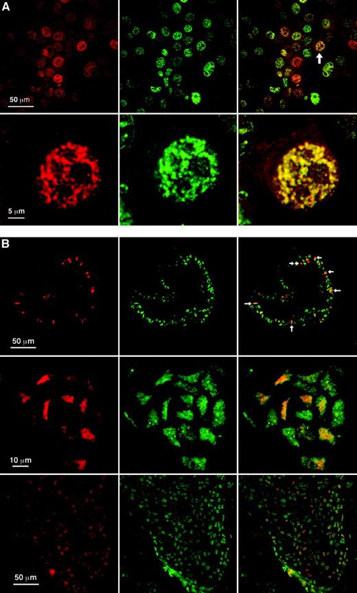 Expression of the Forkhead Transcription Factor FOXP1 Is Associated ...