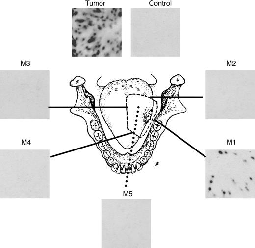 Molecular Diagnosis of Surgical Margins and Local Recurrence in Head ...