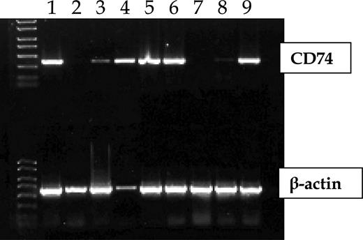 CD74 Is Expressed by Multiple Myeloma and Is a Promising Target for ...