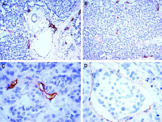 Lymphatic Vessel Density and Vascular Endothelial Growth Factor-C ...