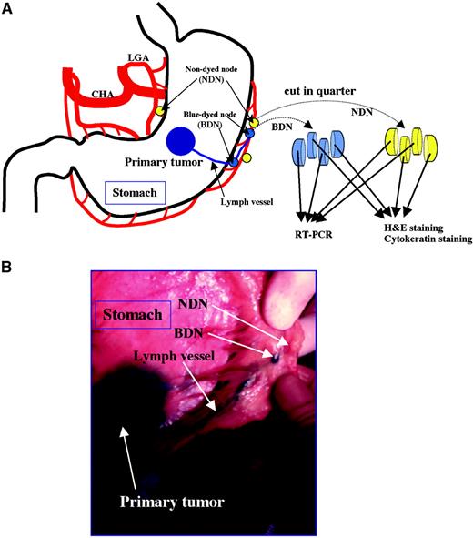 Is a Lymph Node Detected by the Dye-Guided Method a True Sentinel Node ...