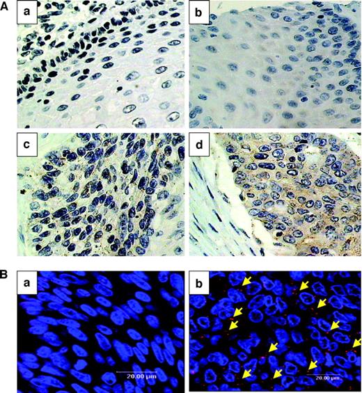 Overexpression of Aurora-A Contributes to Malignant Development of ...
