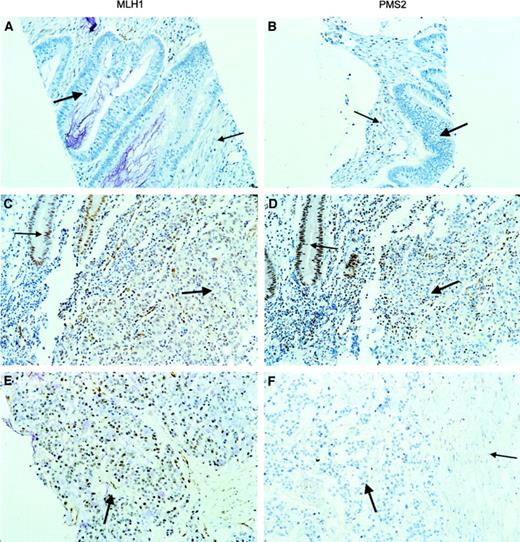 Microsatellite Instability, Immunohistochemistry, and Additional PMS2 ...